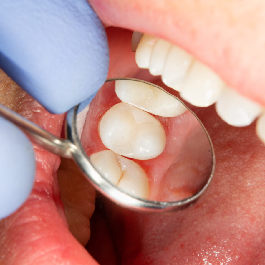 7 Beneficios de los composites universales - Odontomecum Blog
