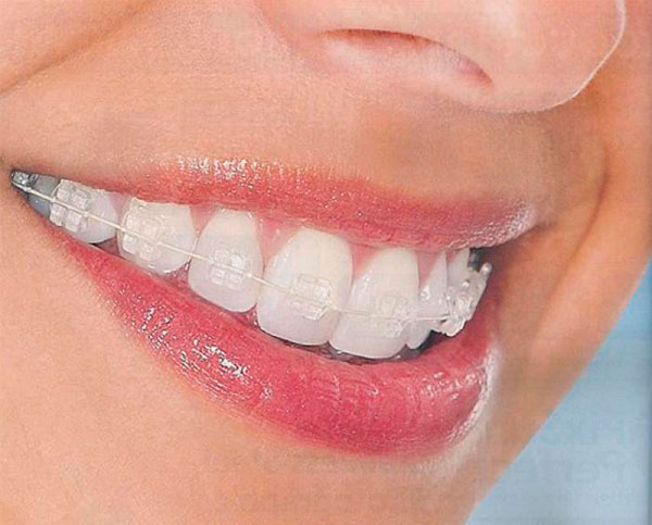 Tipos de brackets: ¿Cuáles son los mejores? Ventajas e inconvenientes
