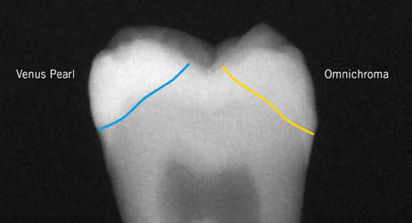 Venus ONE Shade - nuevo composite Venus ONE Shade de Kulzer