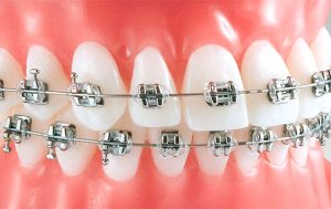 Tipos de brackets: ¿Cuáles son los mejores? Ventajas e inconvenientes